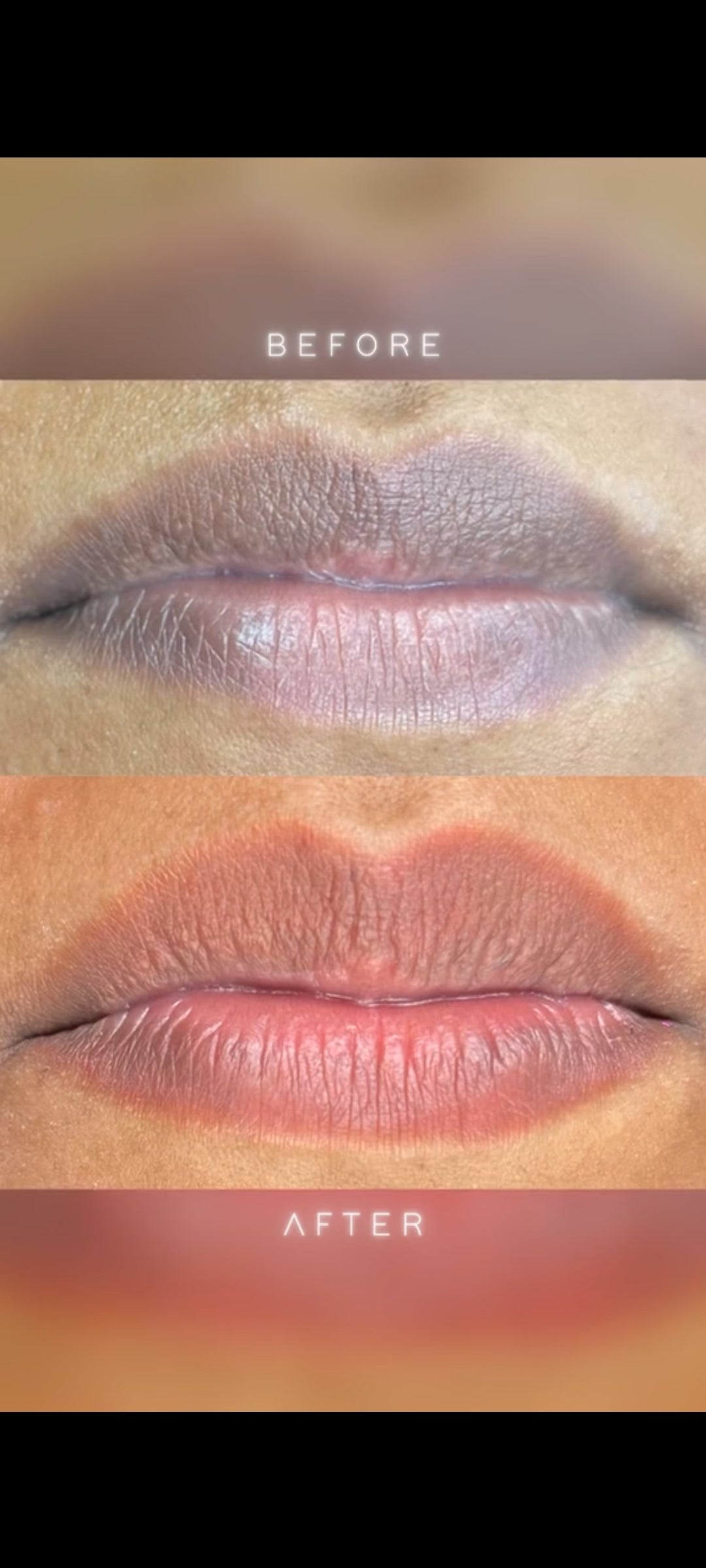 Lip Neutralization – Vanitylaser